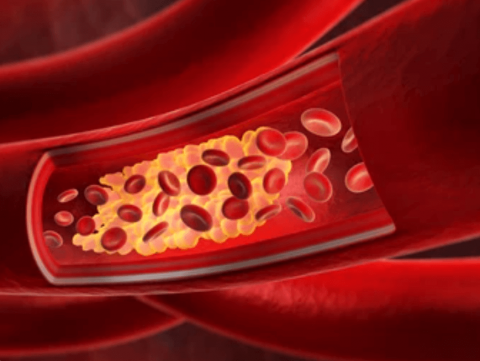 ¿Qué son las Placas de Ateroma? Conoce porque se forman y su ...